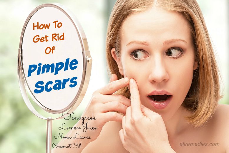 20 Fast Tips How To Get Rid Of Pimple Scars Naturally 20 Fast Tips How To Get Rid Of Pimple Scars Naturally