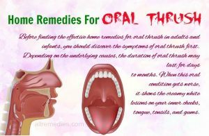 Top 41 Home Remedies for Oral Thrush: Causes, Symptoms, Prevention