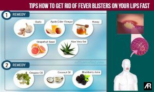 45 Tips How to Get Rid of Fever Blisters on Your Lips Fast