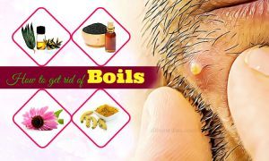 26 Valuable Remedies How To Get Rid Of Boils On Face & Buttocks Fast