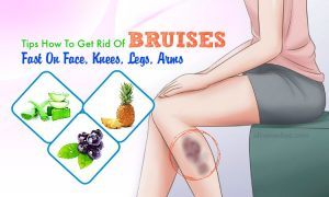 25 Tips How To Get Rid Of Bruises Fast On Face, Knees, Legs, Arms