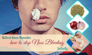 Top 14 Natural Home Remedies How To Stop Nose Bleeding Instantly