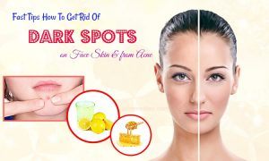10 Fast Tips How To Get Rid Of Dark Spots On Face Skin & From Acne