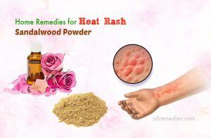 Top 23 Natural Home Remedies For Heat Rash: Causes & Treatments