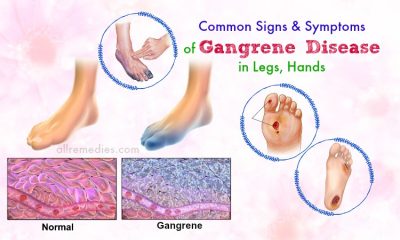 Top 6 Common Signs & Symptoms Of Gangrene Disease In Legs, Hands